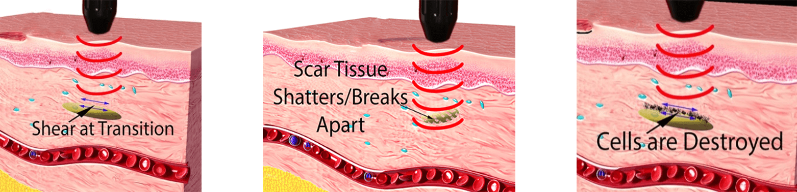 Shockwave Therapy - Infuze MD